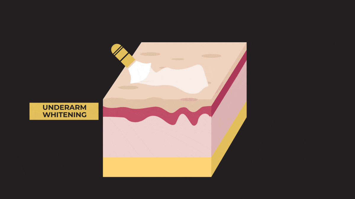 رفع تیرگی زیر بغل با لیزر | روشهای خانگی سفید کردن زیر بغل | کلینیک ...